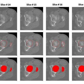Examples Of QCT Slices Top Row With Corresponding Femur Contours Download Scientific Diagram