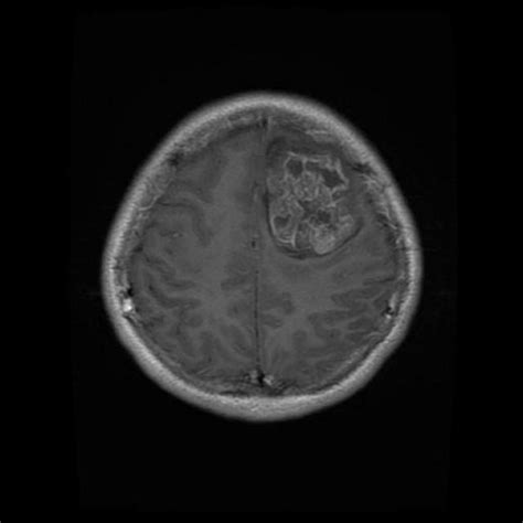3 Types Tumor Detection Object Detection Model By Farhat Abbas