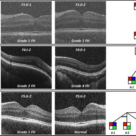 Eye Movement Recordings Original Eye Movement Recordings Emr In