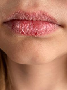 Try These Simple DIY Hacks To Help Get Rid Of A Cold Sore In No Time Viso Labbra Insta