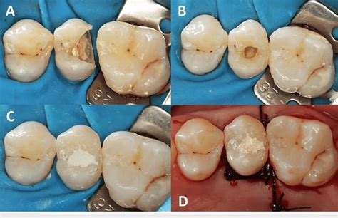Operative Sequence First Session A Absolute Isolation Of The Download Scientific Diagram