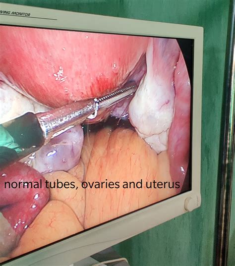 Diagnostic Laparoscopy For Infertility Dr Ruchi Tandon