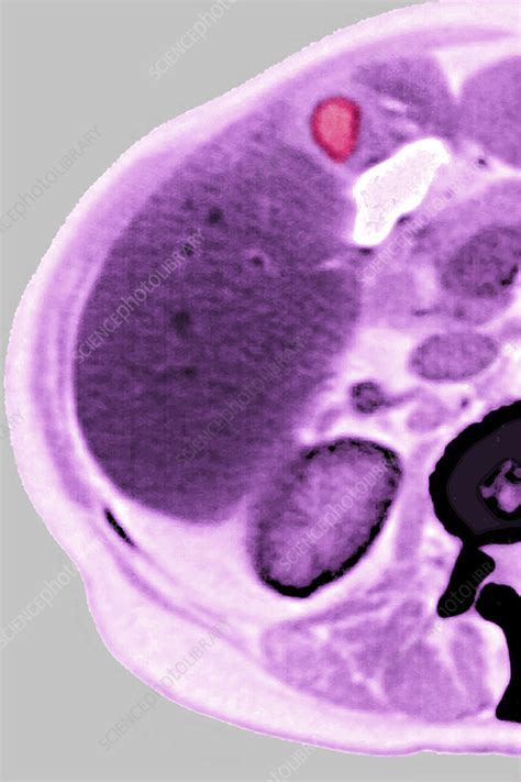 Lymphoma Ct Scan Stock Image C0602218 Science Photo Library