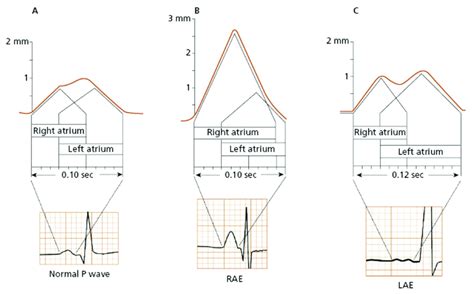 The Visual Representation Of The Atrial Depolarization In A Normal
