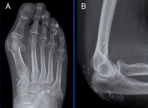 Scleroderma Hands Xray