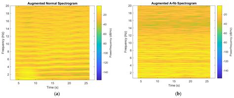 Automated Atrial Fibrillation Detection With Ecg