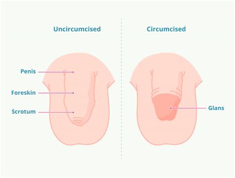 Types Of Circumcision Techniques