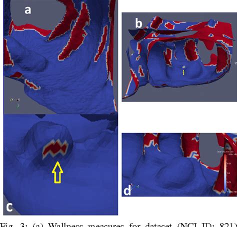Figure 3 From Colorectal Polyp Segmentation Using Front Propagation On Surfaces Guided By Shape