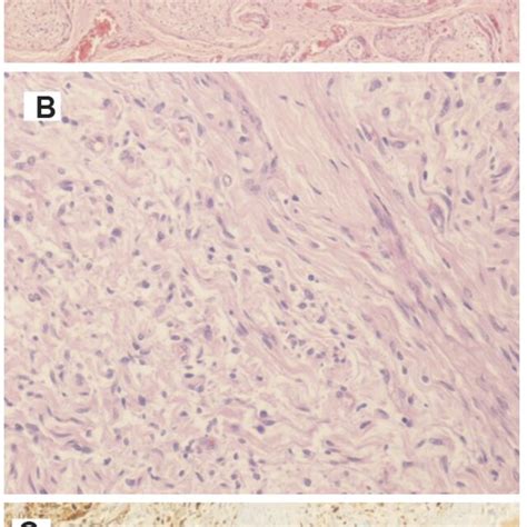 Photomicrograph Of The Plexiform Neurofibroma Histopathological Image