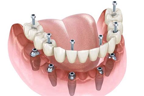 All On 6 Dental Implants In Turkey Comprehensive Guide And Pricing