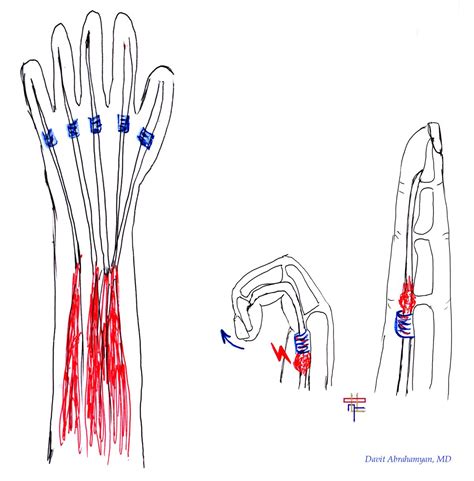 File Trigger Finger Physiopedia