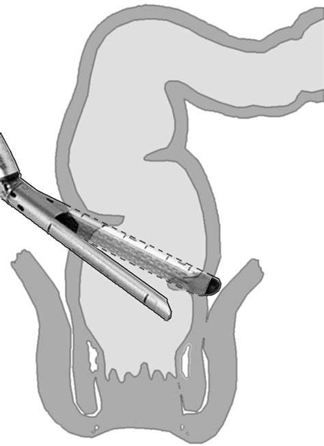 Indications And Surgical Technique For Transanal Proctectomy And Ileal