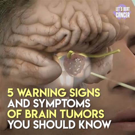 5 Warning Signs And Symptoms Of Brain Tumors You Should Know Brain