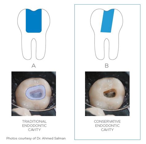 Trunatomy Endodontic Files Dentsply Sirona Mena