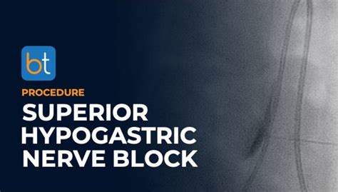 Superior Hypogastric Plexus Block Procedure Backtable Vi