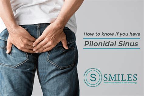 How Do You Know If You Have Pilonidal Sinus Smiles