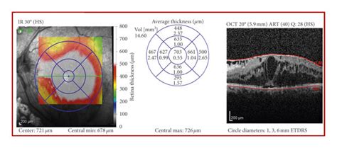 Sample Cases From Group Ii Case 1 A Baseline Oct Scan Of Dme With