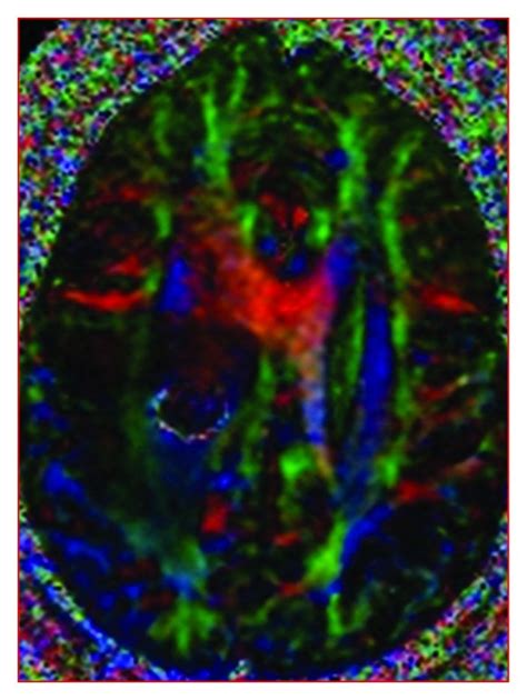 A 43 Year Old Female With Breast Cancer Metastasis To The Posterior