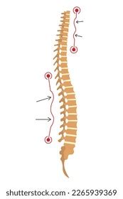 Spinal Deformity Symbol Spine Curvatures Unhealthy Stock Illustration 2265939369 Shutterstock