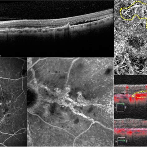 Oct Top Left Panel Shows Abnormal Subretinal Hyper Reflective
