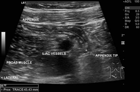 Radiopaedia Appendicitis Appendicitis