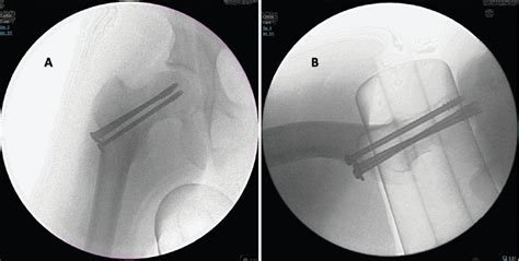 Treatment Of Non Displaced Intracapsular Femoral Neck Fractures With Dynamic Hip And Cannulated