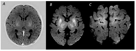 Magnetic Resonance Imaging In Near Term Infants With Hypoxic Ischemic Encephalopathy