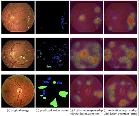Interpretable And Interactive Disease Diagnosis Using Collaborative Learning Of Segmentation And