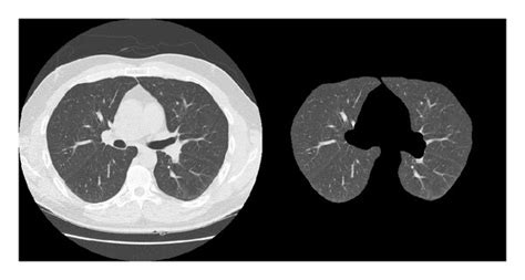 original ct image and the result after applying the preprocessing stage