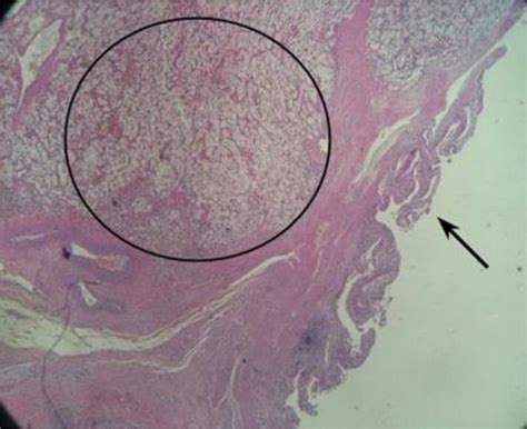 Gallbladder With Areas Of Mucosal Erosion Arrow And Metastatic Download Scientific Diagram