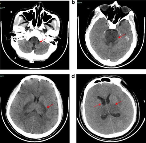 Abnormal Head Ct Imaging Head Ct Appearance Of The Medulla Oblongata