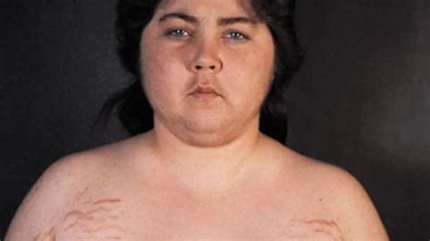 Qué Es El Síndrome De Cushing La Enfermedad Que Te Pone La “cara De Luna Llena” Infobae