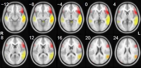 Presurgical Language Mapping With Resting State And Movie Watching Fmri