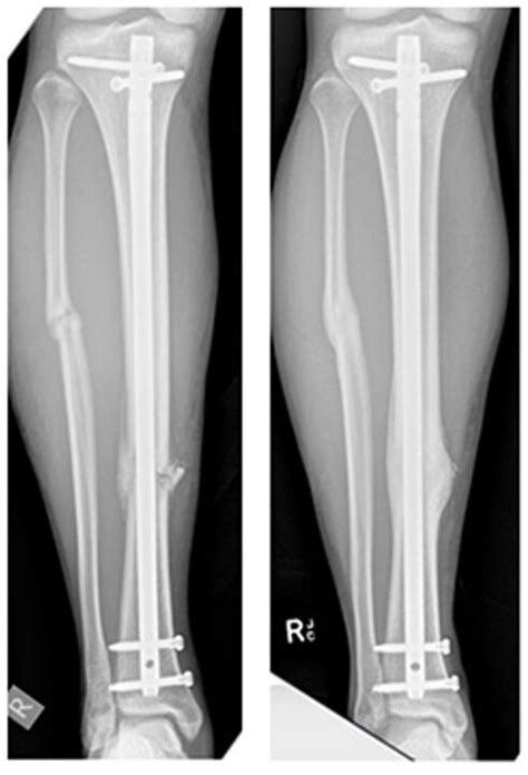 Fractured Tibia Treatments