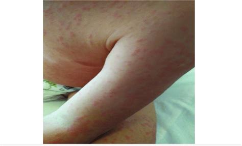 Maculo Papular Rashes In The Trunk Arm And Thigh Download Scientific Diagram