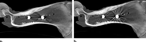 Effect Of Collimation On Metal Related Artifacts A Comparison Of Ct Download Scientific