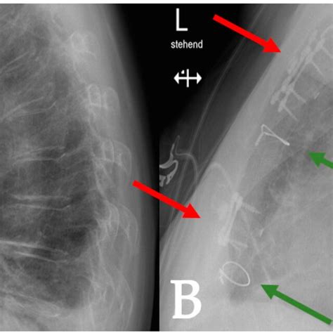 Comparison Of Enhanced Sternal Closure Using The A Sl360 Alone Red Download Scientific