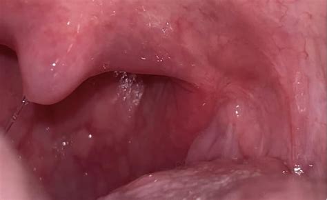 Tonsil Regrowth Rtonsilstones