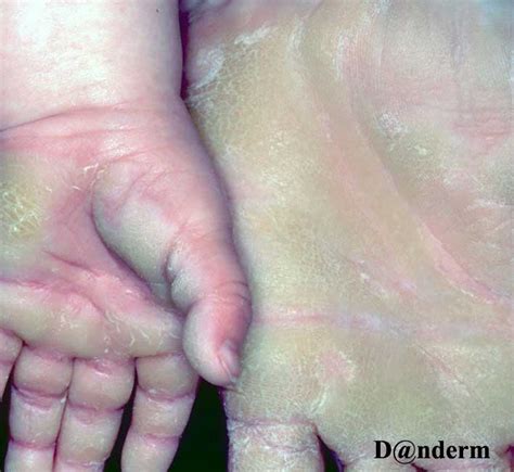 5 65 1 Diffuse Palmar Keratoderma In Two Generations