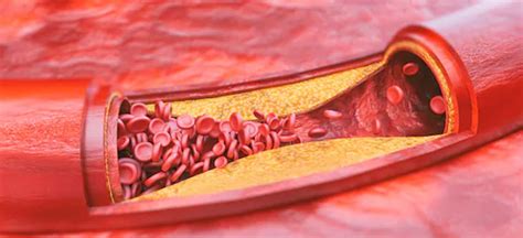 Atherosclerosis Definition Of Atherosclerosis