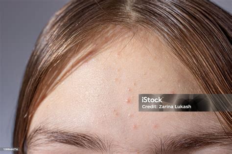십대 소녀의 이마에 여드름 어린이의 피부 문제 피부과 여드름 치료 여드름에 대한 스톡 사진 및 기타 이미지 여드름 뾰루지 십대 소녀 Istock