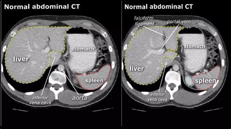 Liver Segment Anatomy Ct Scan Pptx Digestive Disorders Diseases And Conditions