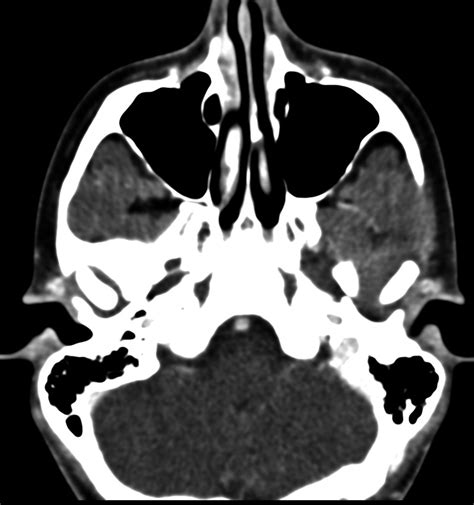 Idiopathic Mandibular Condyle Resorption Pmc