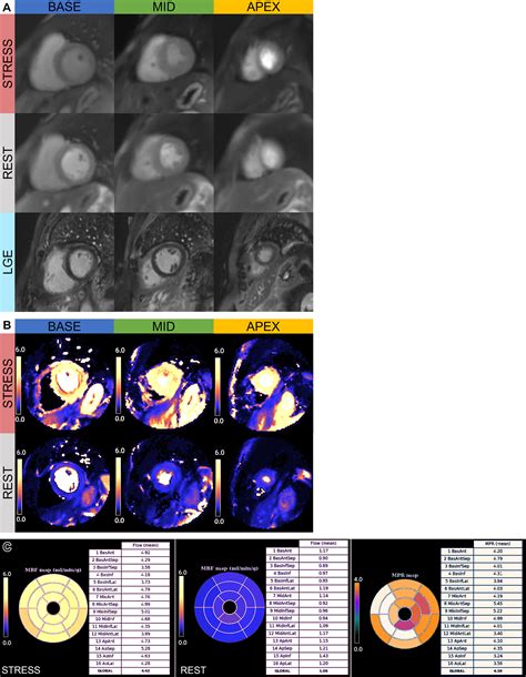 Quantitative Stress First Pass Perfusion Cardiac Mri State Of The