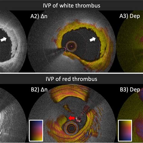Working Principle Of Intravascular Polarimetry Ivp With Download