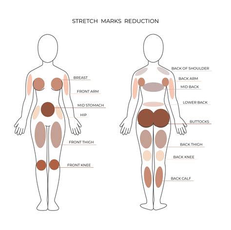 Smooth And Reconstruct Your Skin With AskCares Stretch Marks Treatment Book Now AskCares