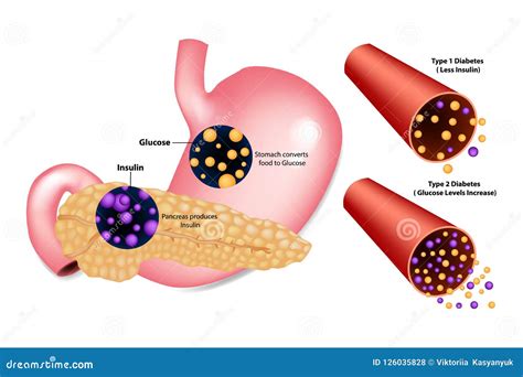 Pancreas Diabetes