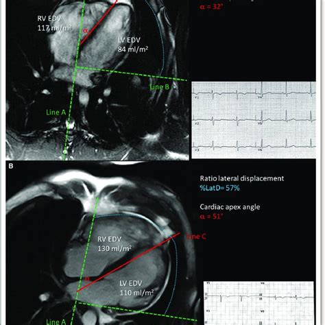 Relationship Between Extent Of T Wave Inversion Across Precordial Leads Download Scientific