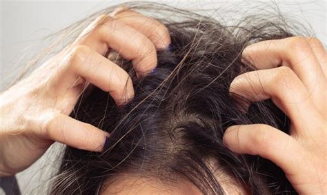14 Natural Remedies For Dry And Itchy Scalp