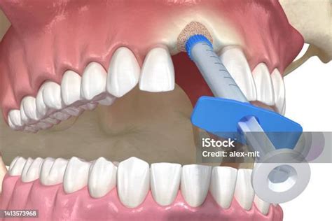 뼈 이식 확대 소켓 보존 치아 이식 의학적으로 정확한 3d 일러스트레이션 풍선껌에 대한 스톡 사진 및 기타 이미지 풍선껌 성장 개념 콘센트 Istock